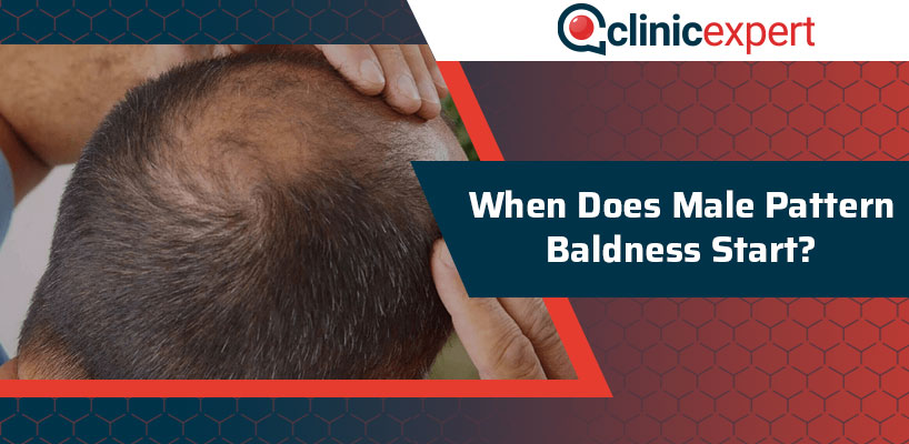 Signs of Balding & Its stages- What to do if your head becomes Bald ...